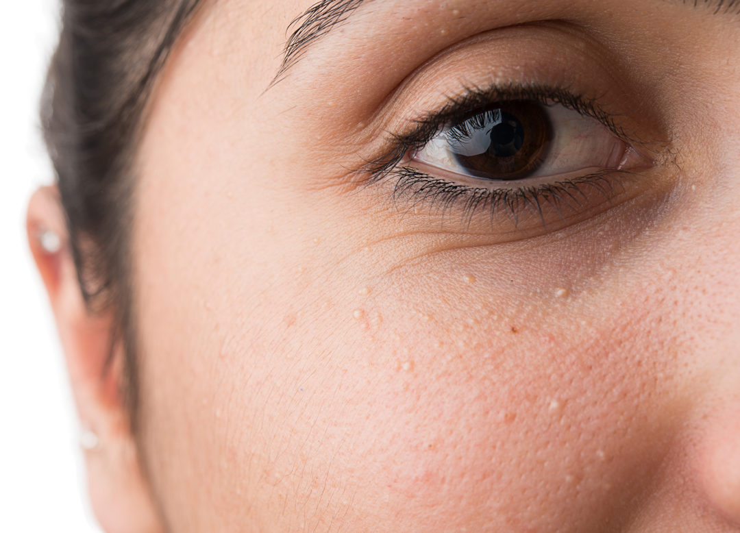 The Ultimate Guide To Milia Under Eye Treatment Realself News 3507