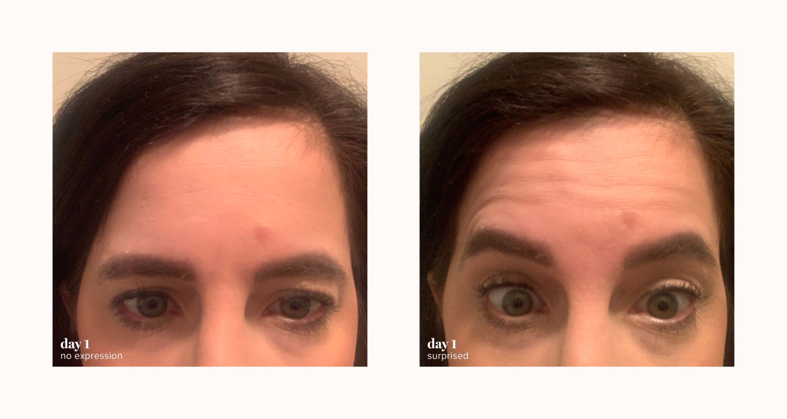 Jeuveau Vs Botox Whats The Difference Realself News