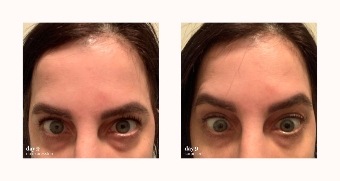 Jeuveau vs. Botox: What’s the Difference? | RealSelf News