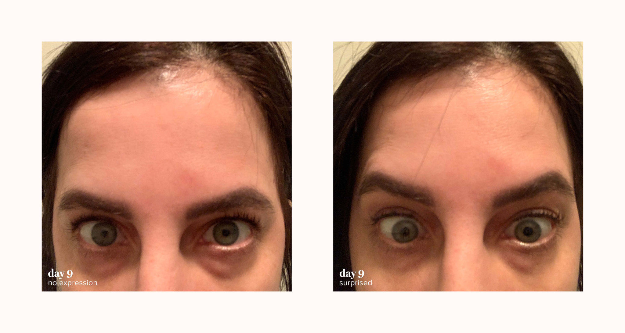 Jeuveau vs. Botox: What’s the Difference? | RealSelf News