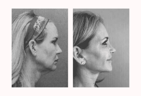 Facelift Surgery Gave Me Confidence at Work | RealSelf News