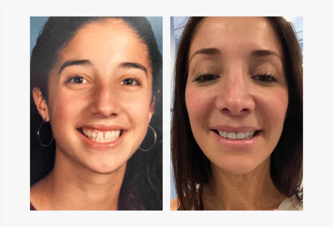 Veneers Process & What to Expect | RealSelf News