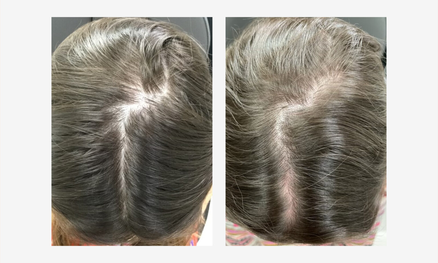 I Tried PRFM Injections for Hair Loss | RealSelf News