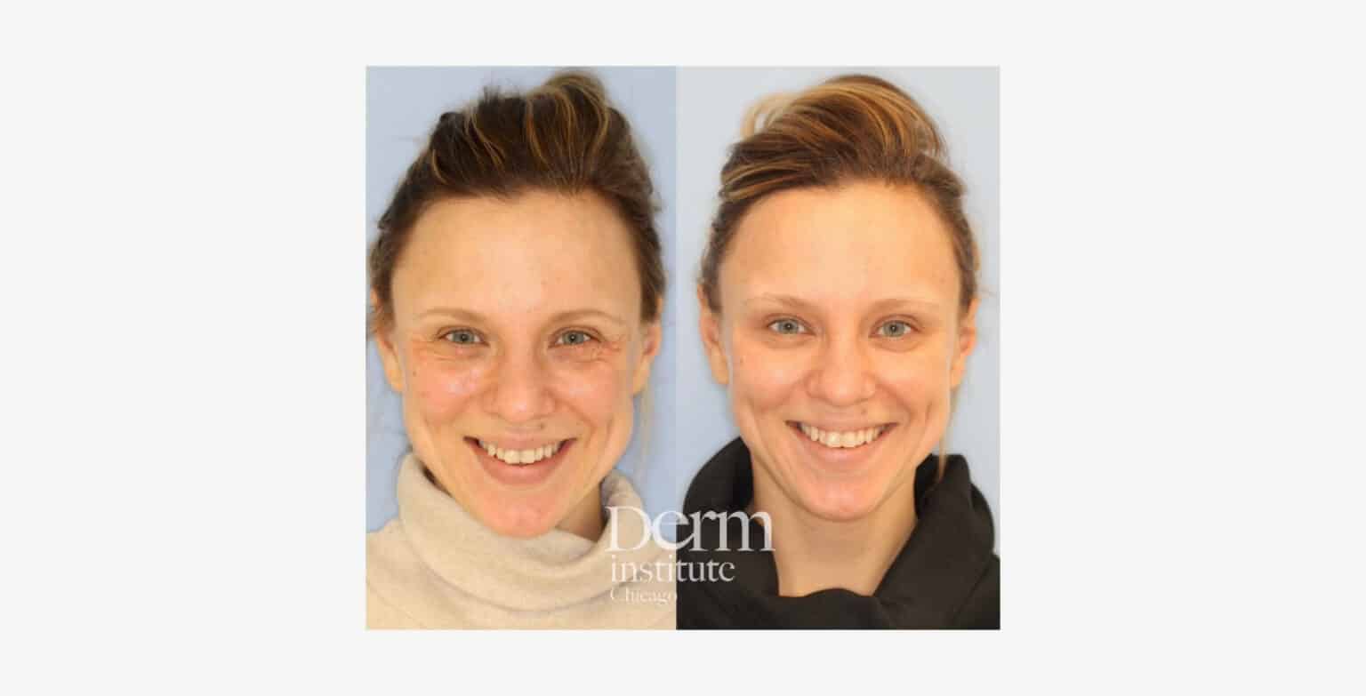 What Are Dennie-Morgan Lines and How to Treat Them | RealSelf News