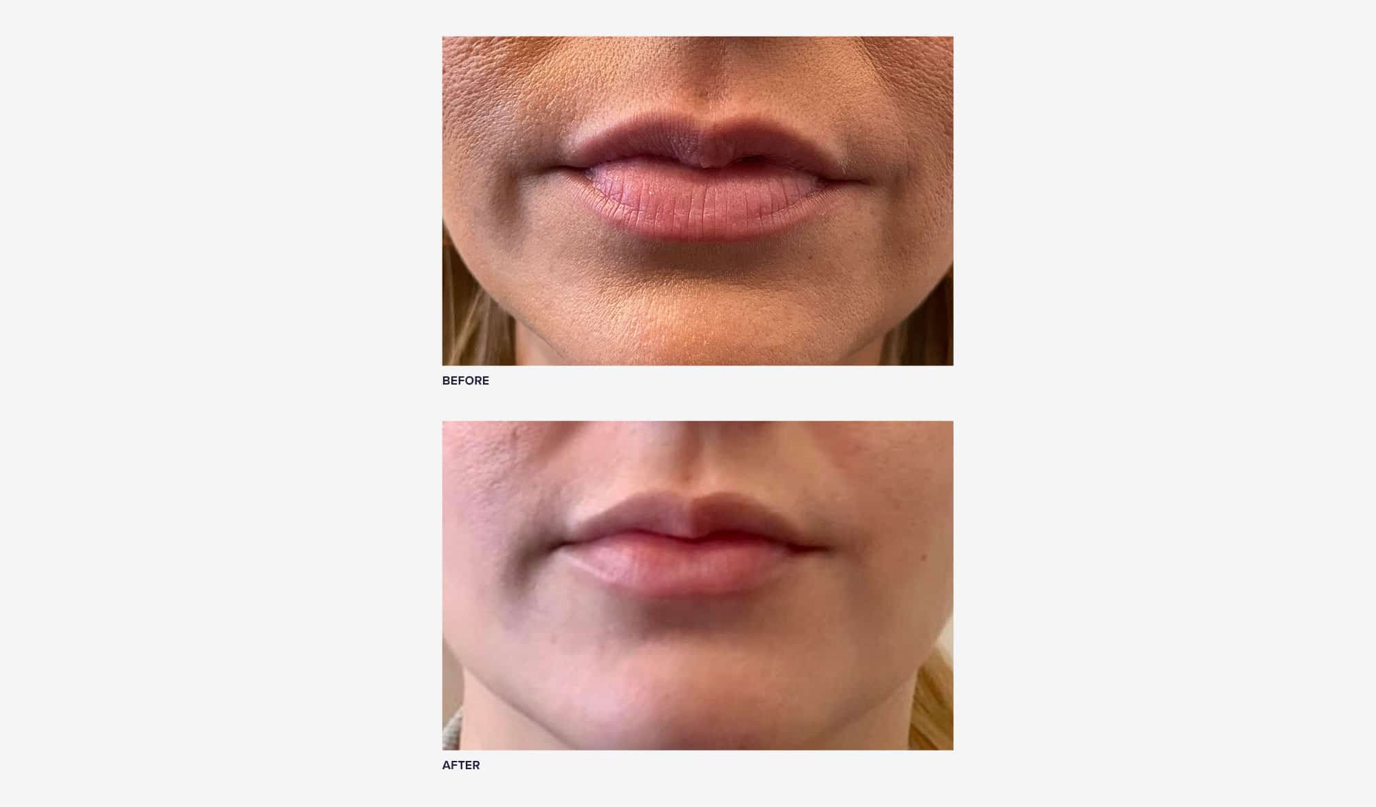 Botox Lip Flip vs. Lip Filler: Pain Level & Results | RealSelf News