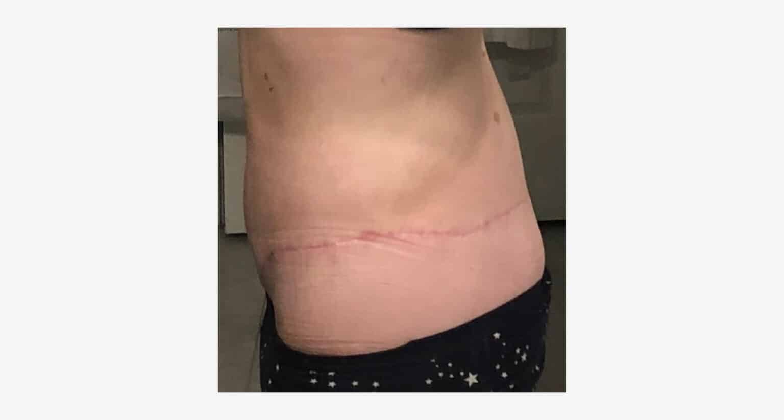 What Real Tummy Tuck Scars Look Like On 12 Patients Realself News 4656
