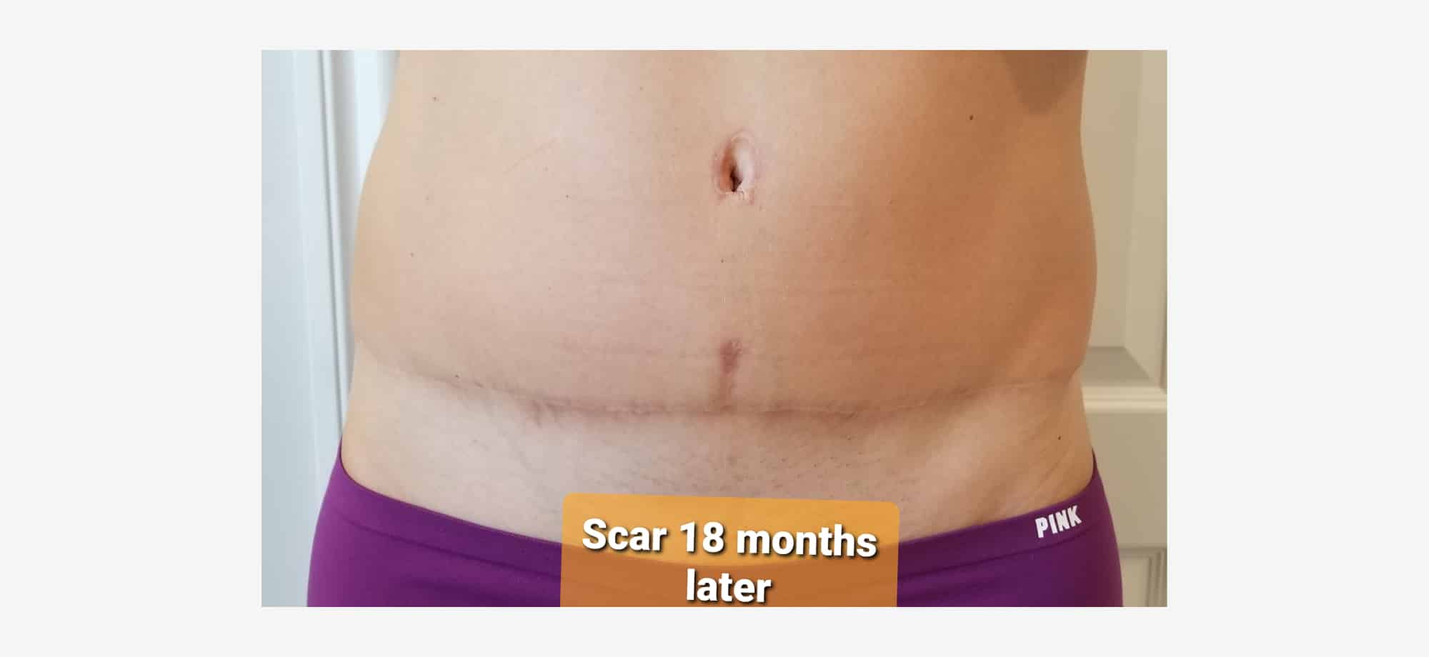 What Real Tummy Tuck Scars Look Like On 12 Patients Realself News 0623