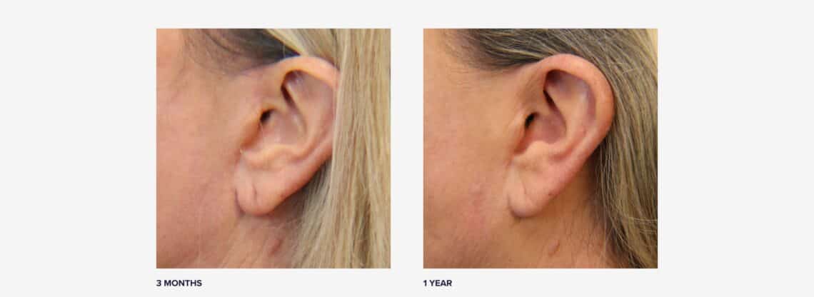 What Real Facelift Scars Look Like on 11 Patients | RealSelf News