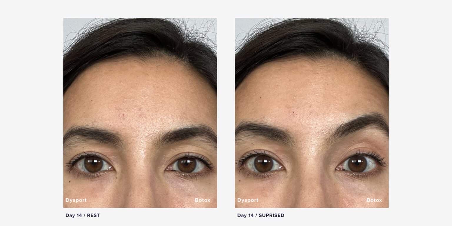 Dysport vs. Botox: What's the Difference? | RealSelf News