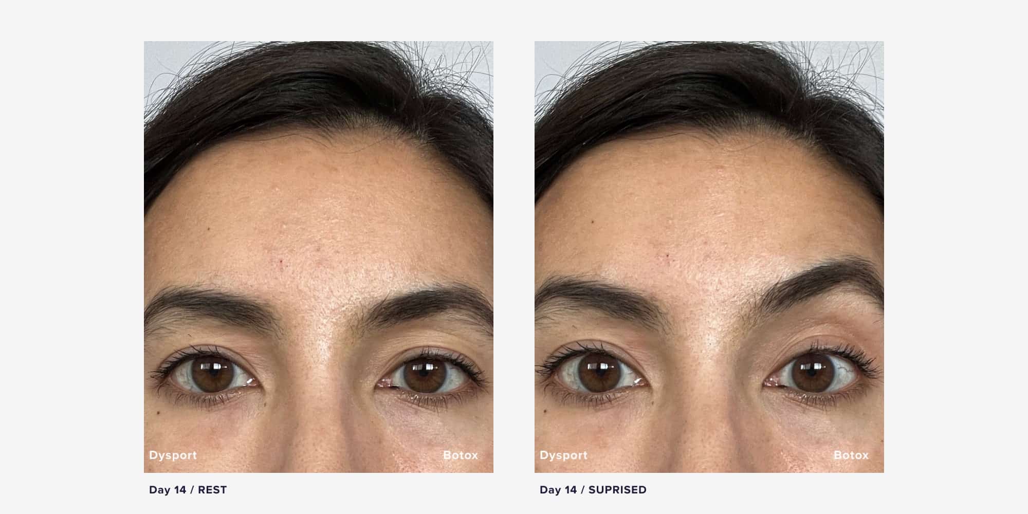 Dysport vs. Botox: What's the Difference? | RealSelf News