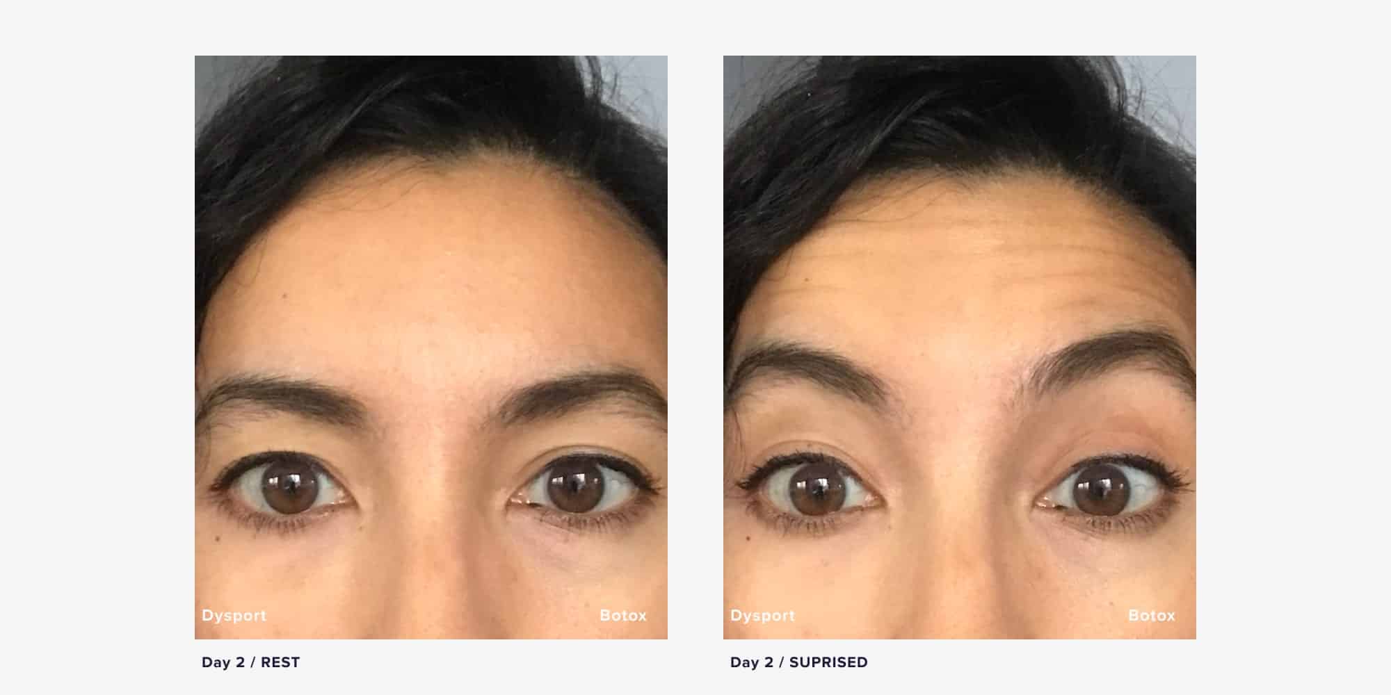 Dysport vs. Botox: What's the Difference? | RealSelf News