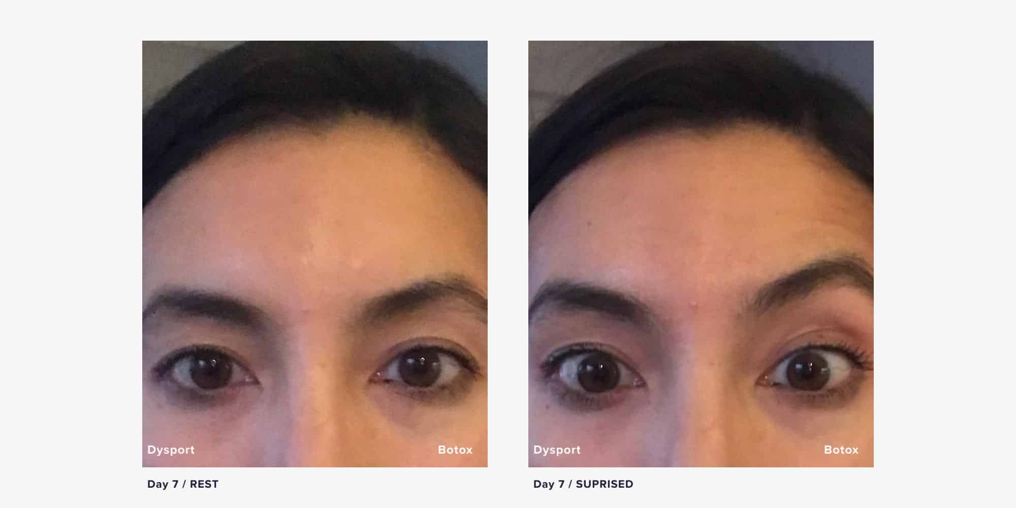 Dysport vs. Botox: What's the Difference? | RealSelf News