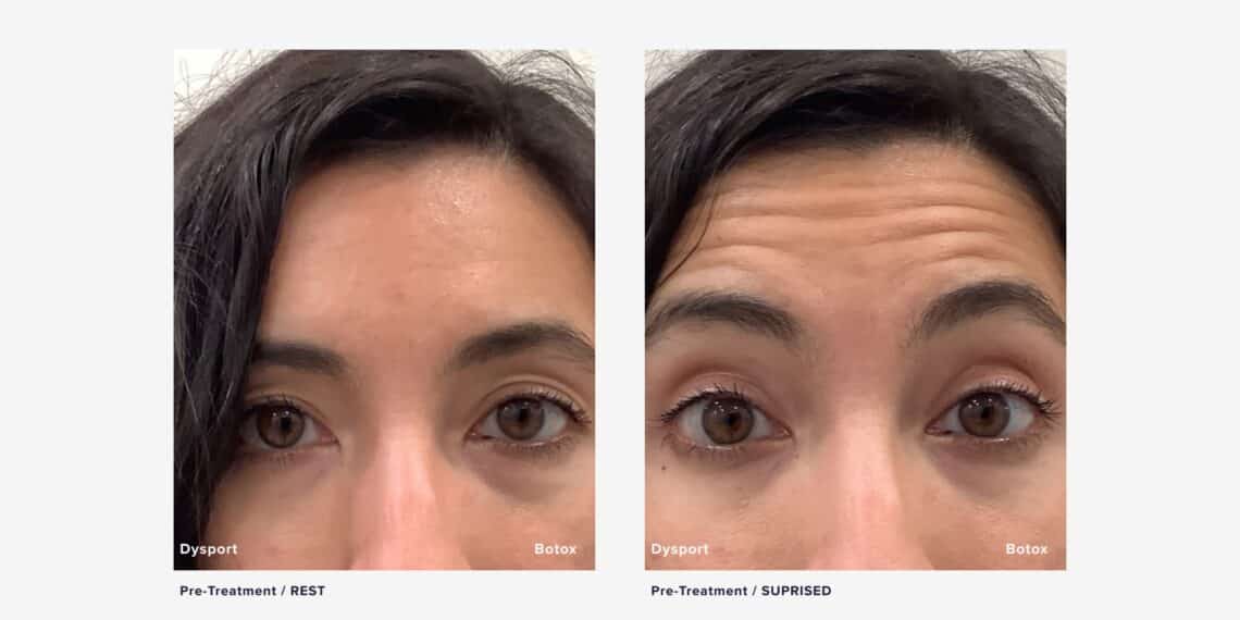 Dysport vs. Botox: What's the Difference? | RealSelf News