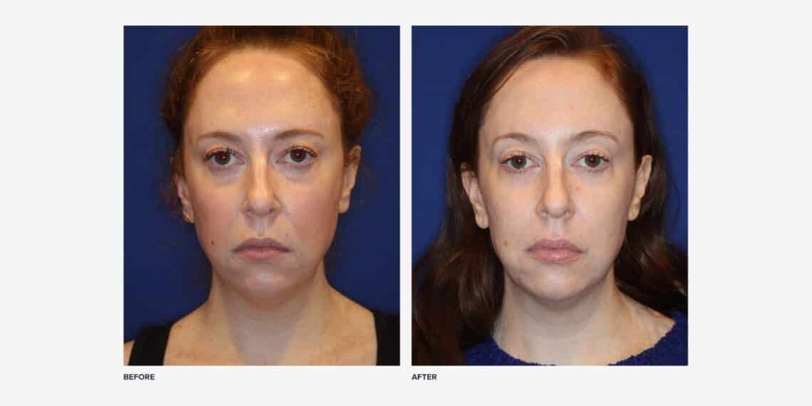 4 Things to Look for in Ultherapy Before and After Photos | RealSelf News
