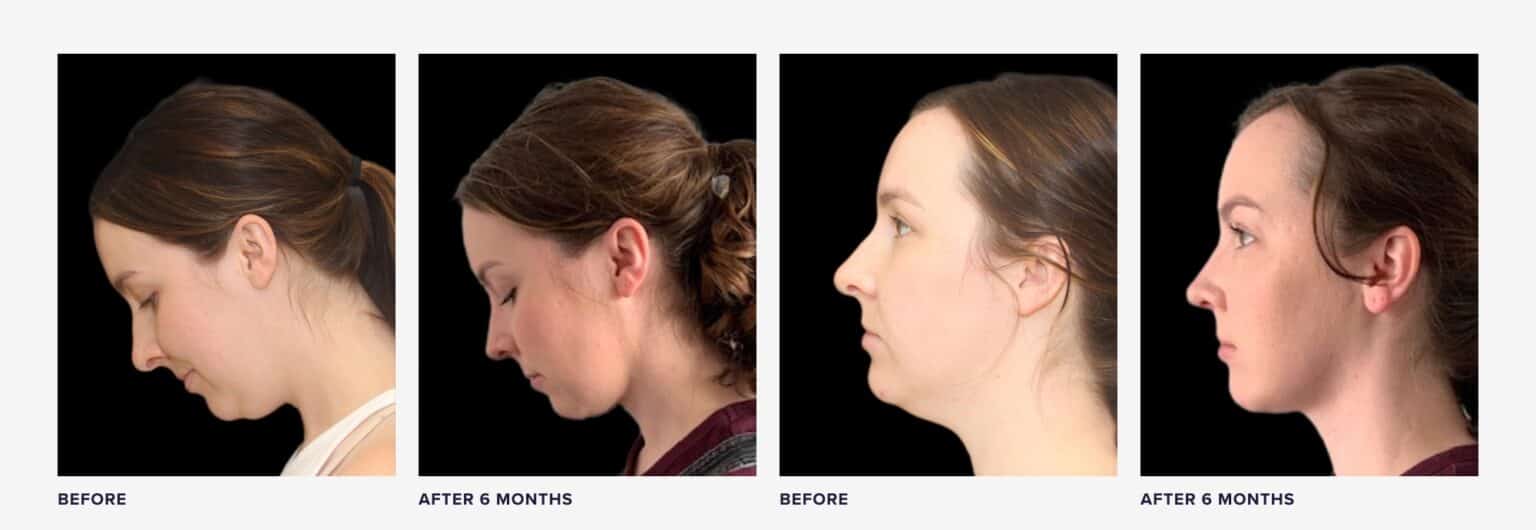 I Got a Neck Lift at 25 to Remove a Genetic Double Chin | RealSelf News