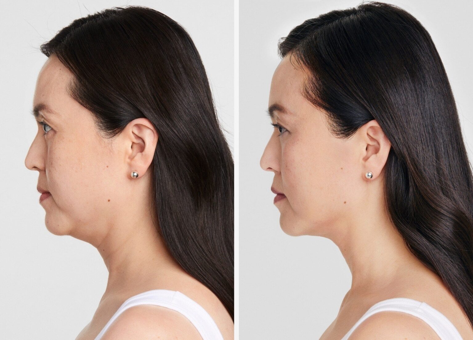 What It's Really Like to Get Ultherapy | RealSelf News