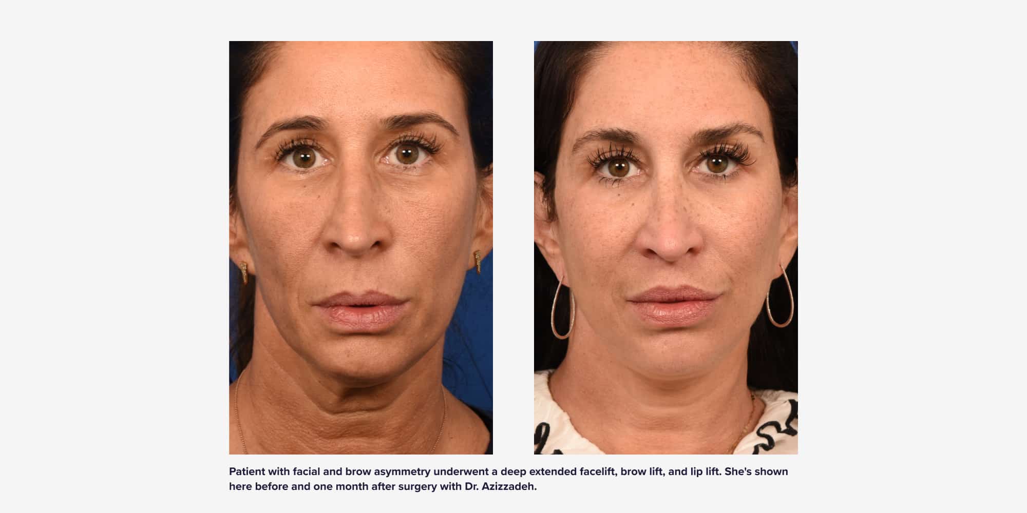 8 Things to Look For in Facelift Before-and-Afters | RealSelf News