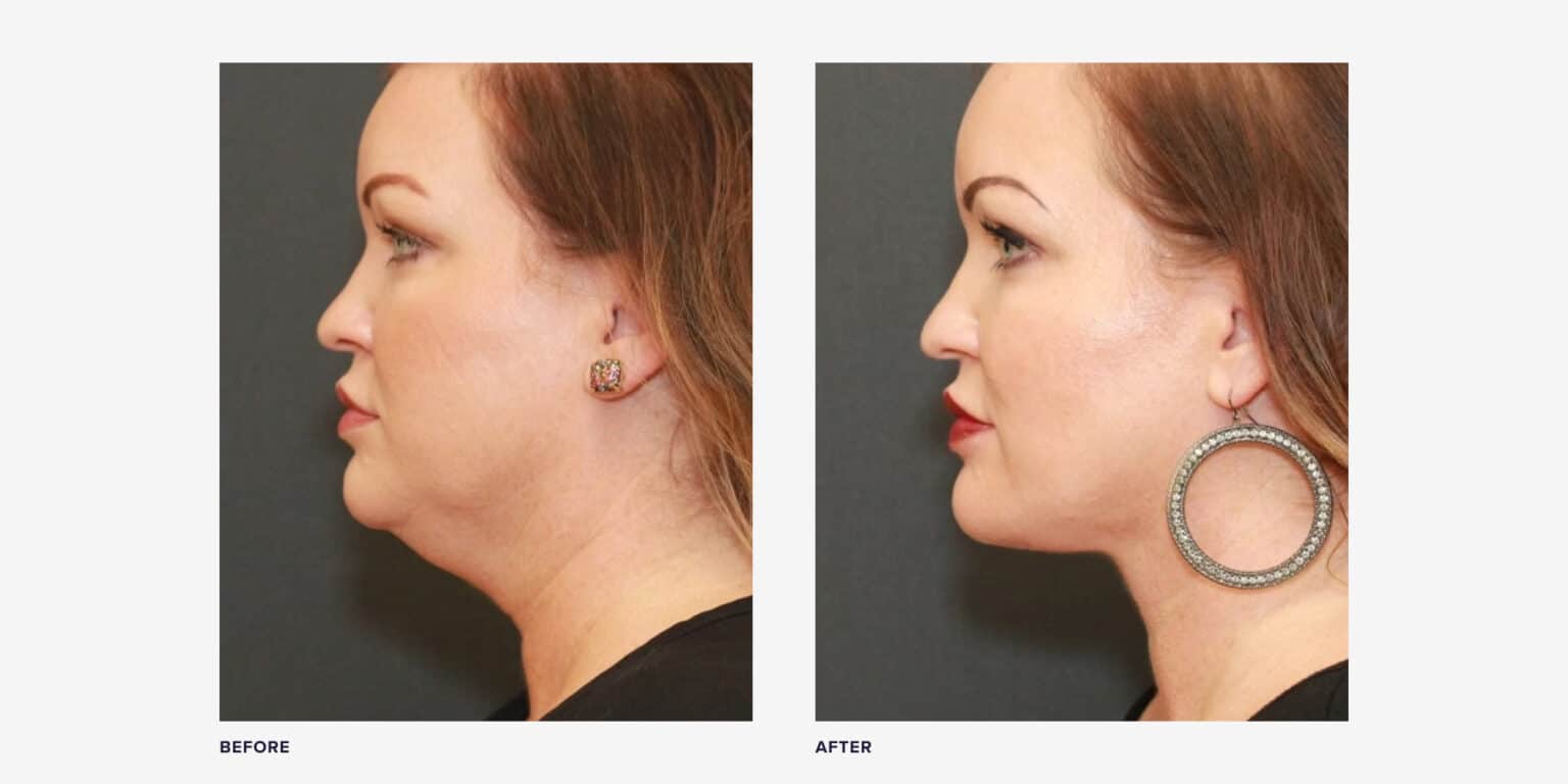 4 Things to Look for in Neck Lift Before and After Photos | RealSelf News