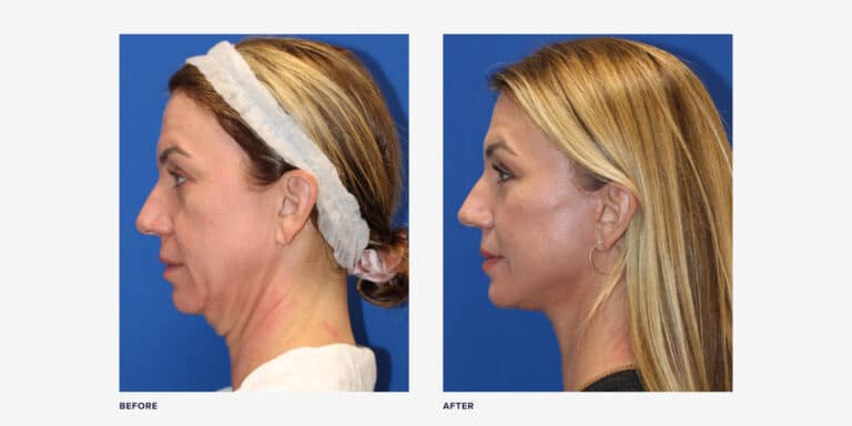 4 Things to Look for in Neck Lift Before and After Photos | RealSelf News