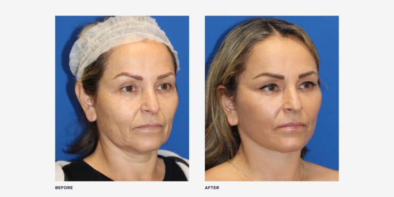 4 Things to Look for in Neck Lift Before and After Photos | RealSelf News