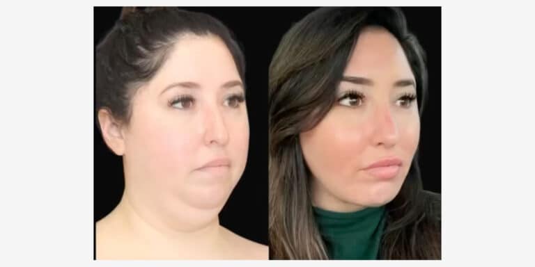 4 Signs of Good Buccal Fat Removal Results | RealSelf News