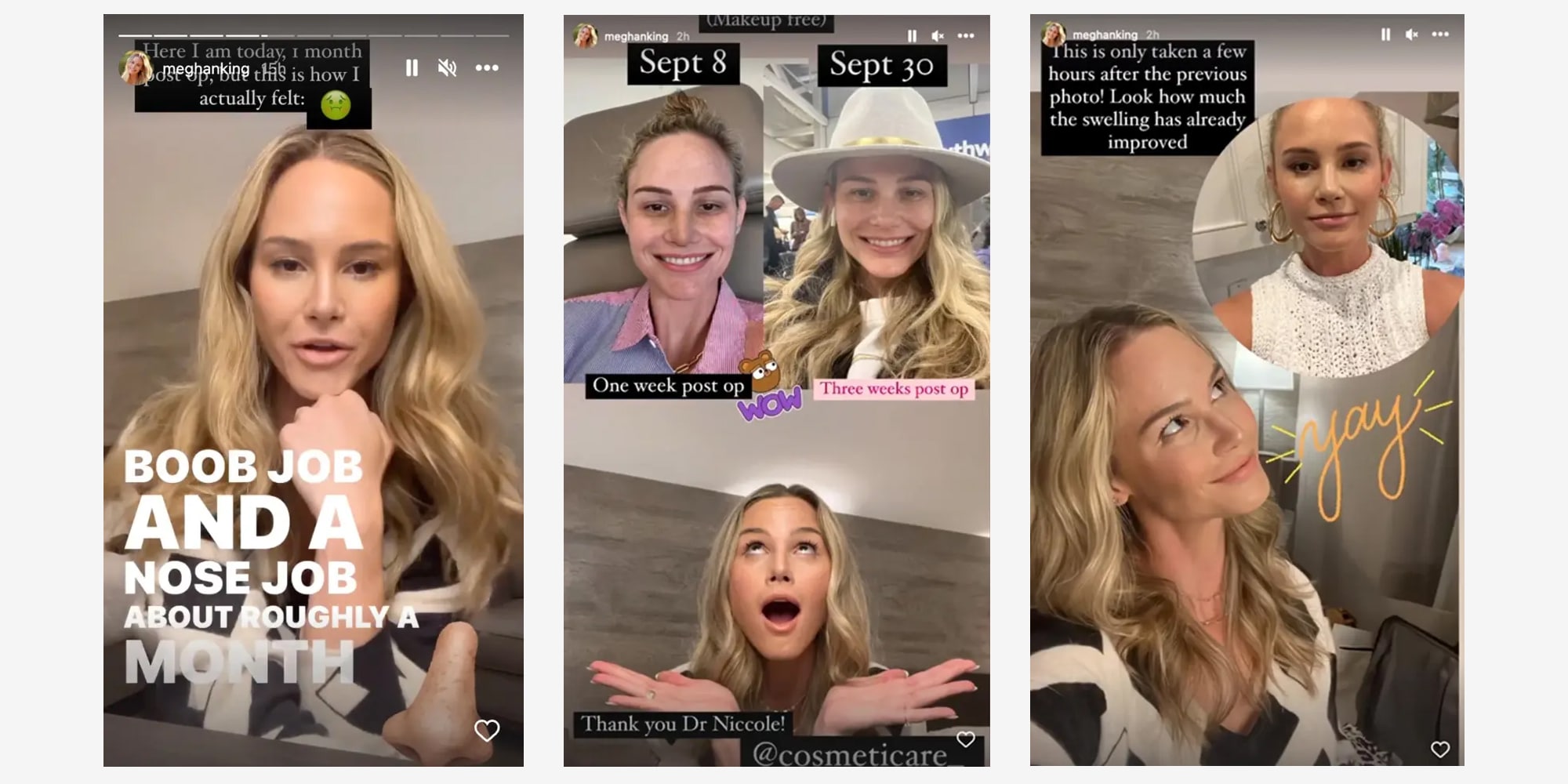 Meghan King Nose Job and Breast Augmentation Details | RealSelf News