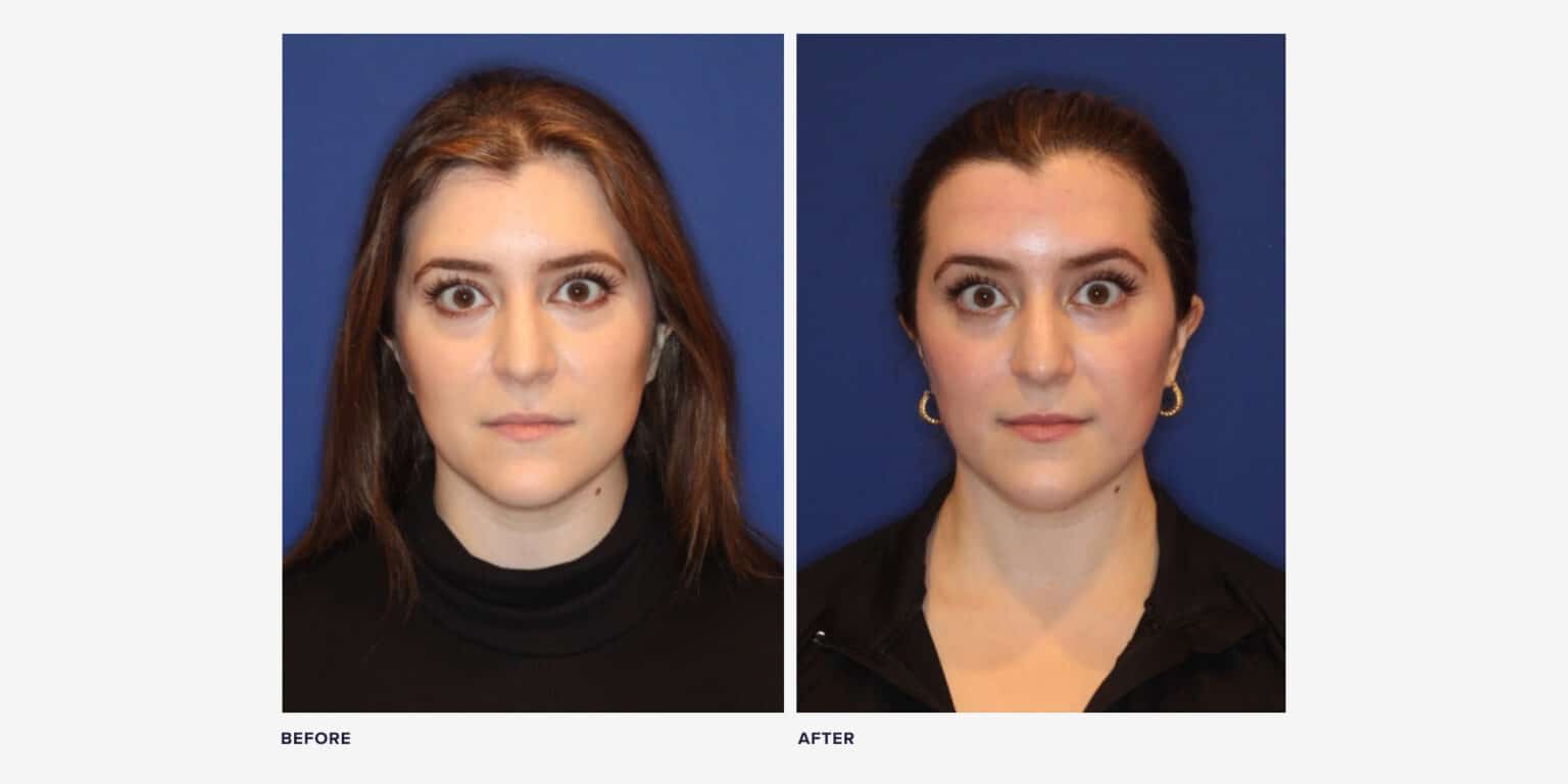 Emface Before and After Photos: Are the Results Worth It? | RealSelf News