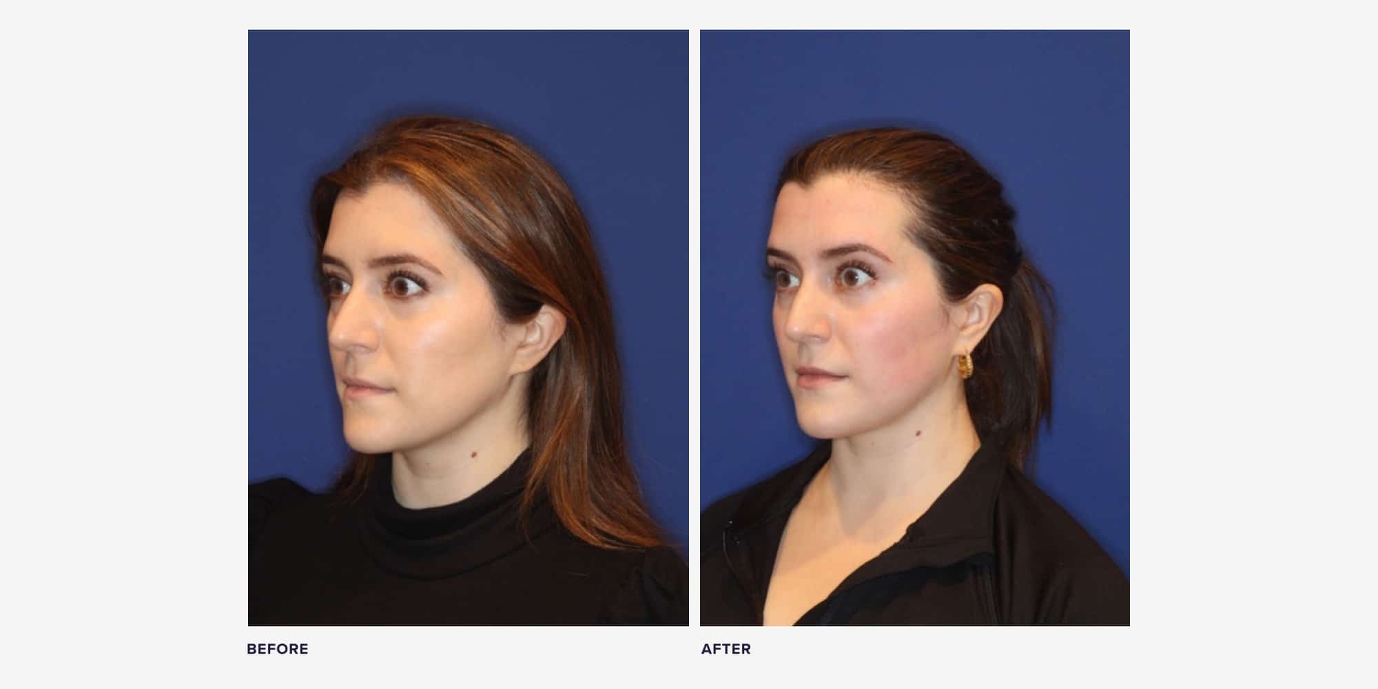 Emface Before and After Photos: Are the Results Worth It? | RealSelf News