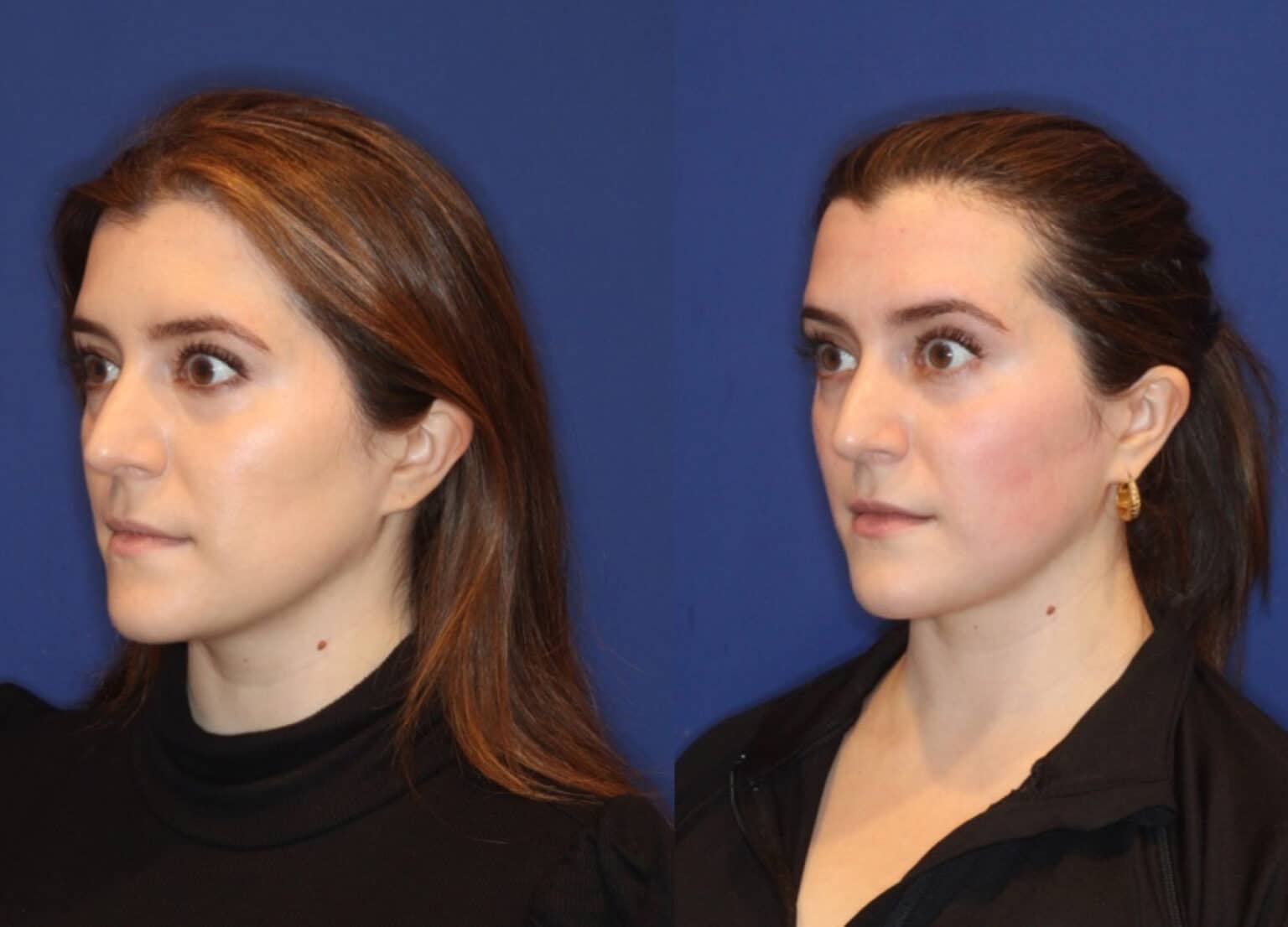 Emface Before and After Photos: Are the Results Worth It? | RealSelf News