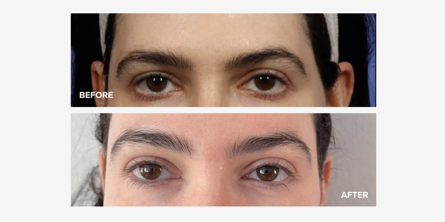 Brow Lift Before & After Photos and What It Felt Like | RealSelf News
