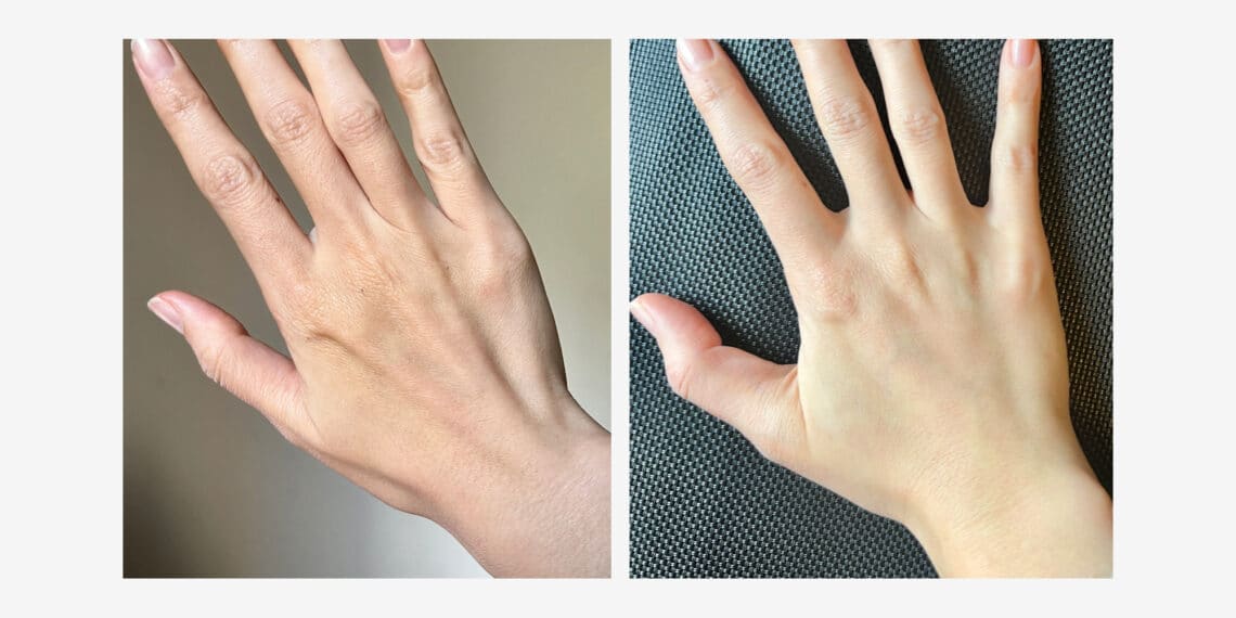 My Renuva Review 2023: Pain, Results & Cost | RealSelf News