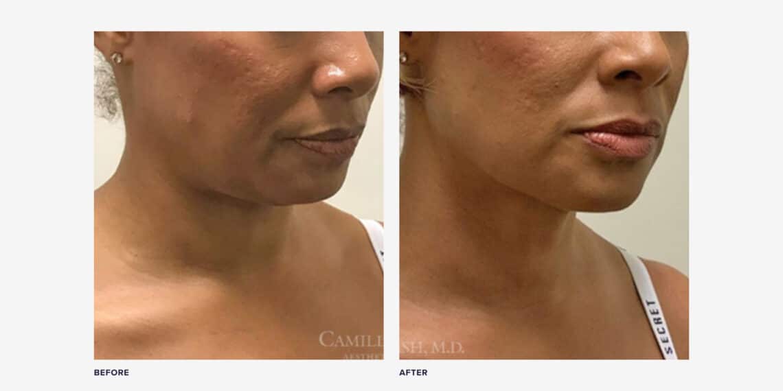 The Best Morpheus8 Before and After Photos | RealSelf News