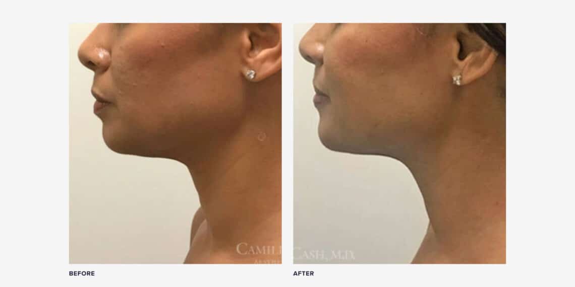 The Best Morpheus8 Before and After Photos | RealSelf News