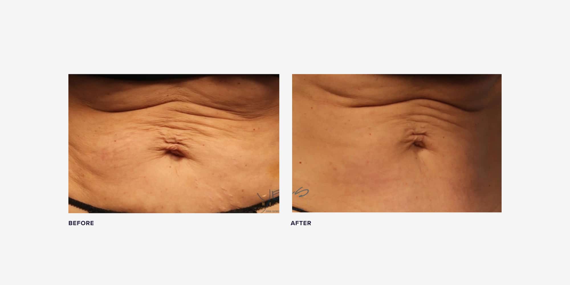 The Best Morpheus8 Before and After Photos | RealSelf News