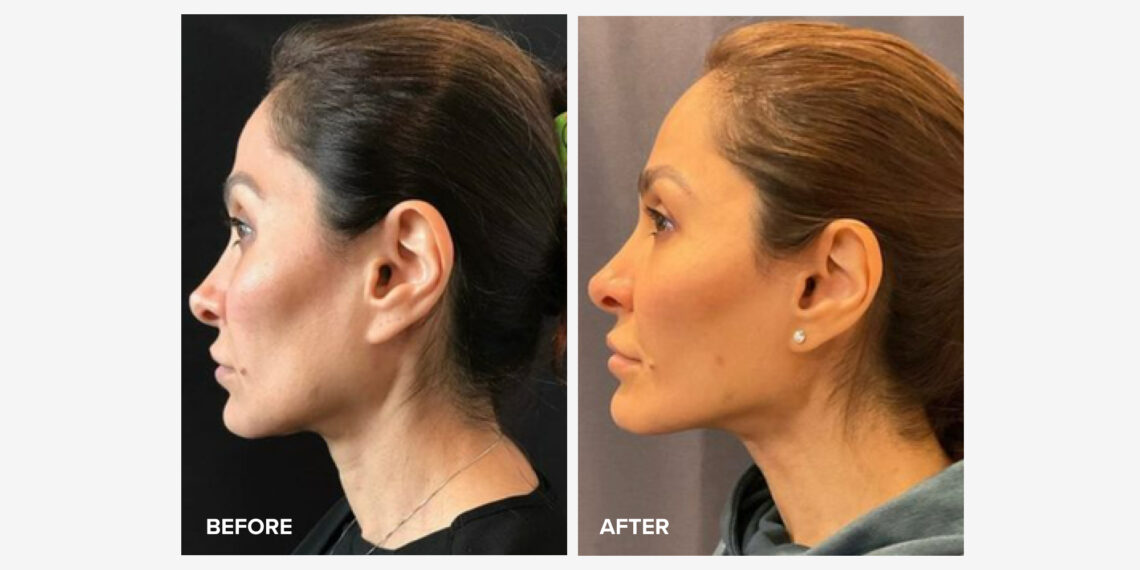 Emface Before and After Photos: Are the Results Worth It? | RealSelf News