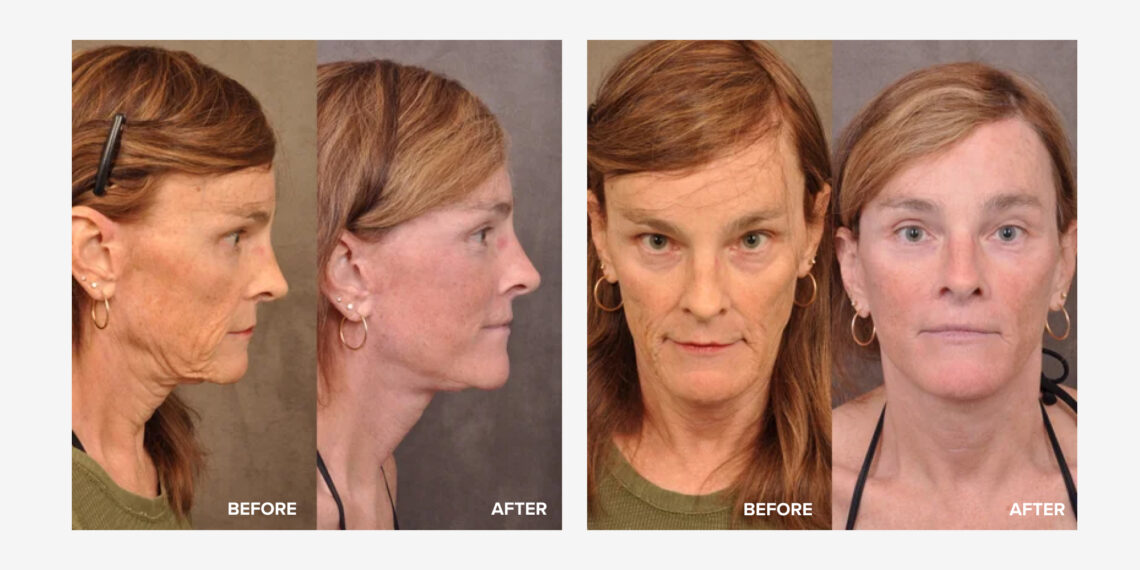My Facelift Revision Results and Experience | RealSelf News