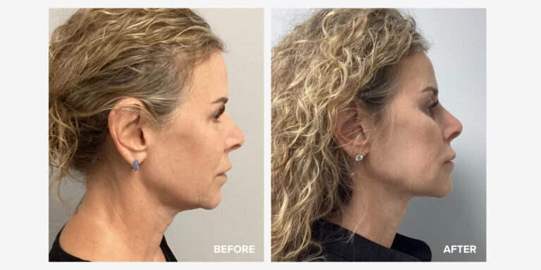 My FaceTite Review and Before and After Photos | RealSelf News