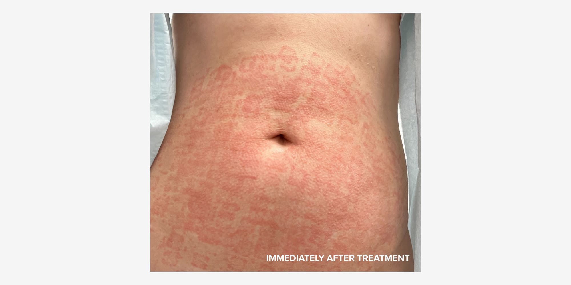 Morpheus8 Stomach Before and After Photos | RealSelf News