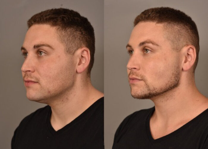 Buccal Fat Removal and Neck Liposuction Review | RealSelf News