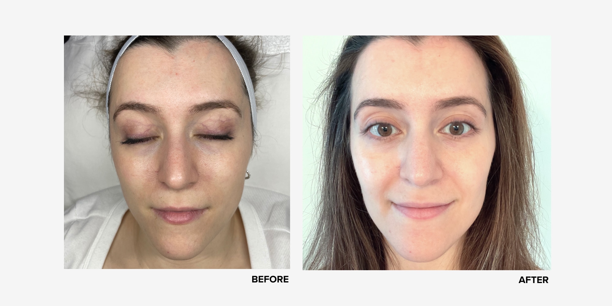 Cellstory Liquid Microneedling Treatment | RealSelf News