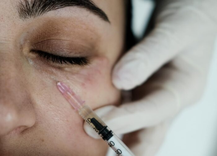 10 Things to Know Before Getting Temple Filler | RealSelf News