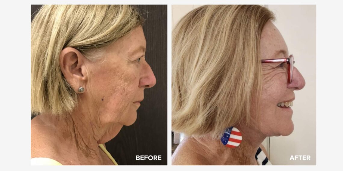 I Got a Facelift at 78 | RealSelf News