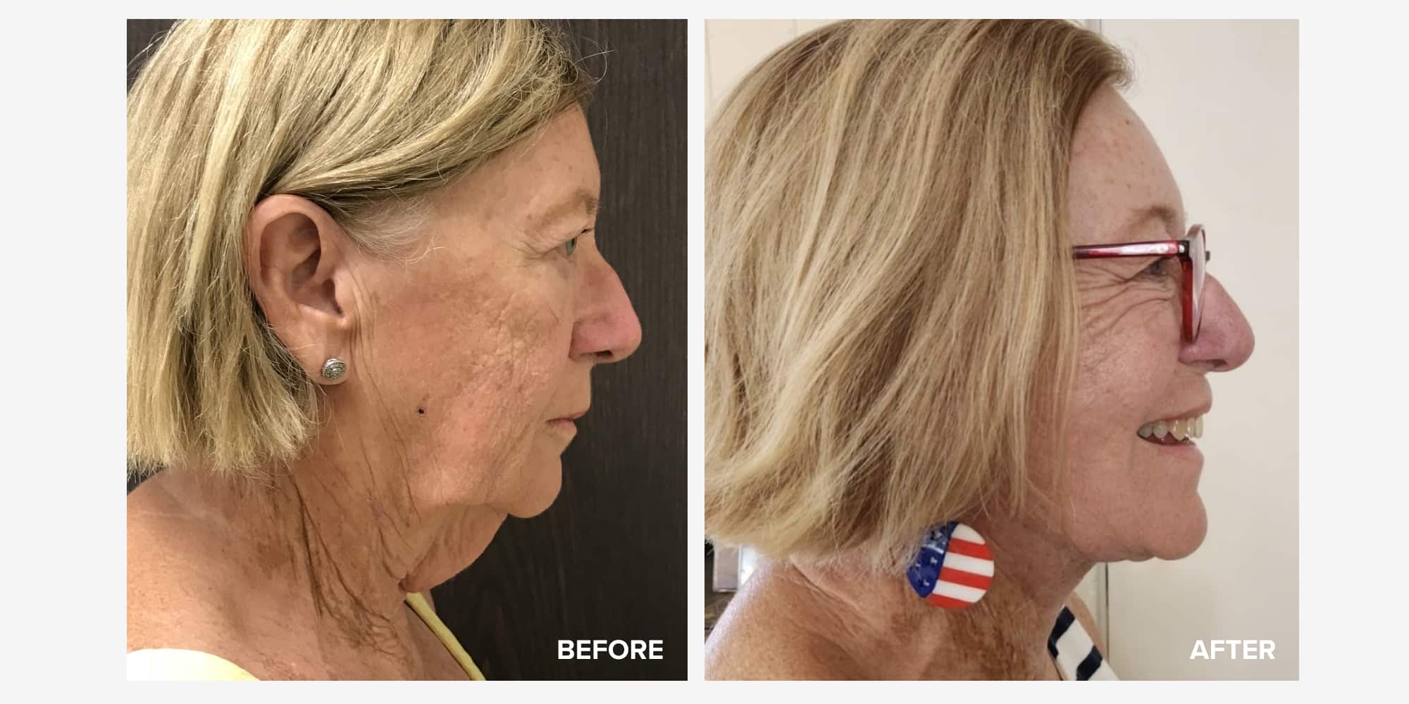 I Got a Facelift at 78 | RealSelf News