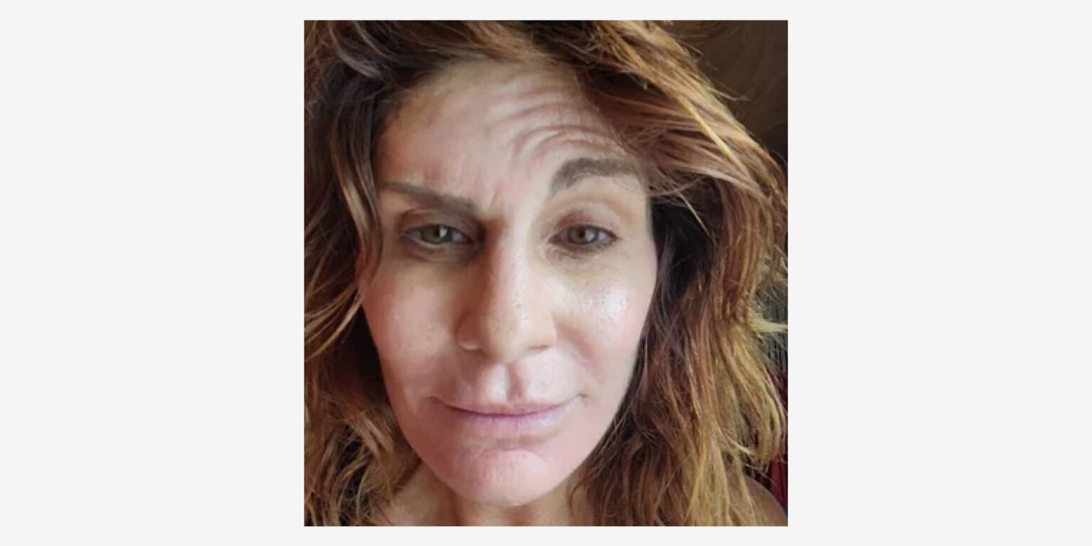 5 Signs of a Botched Facelift | RealSelf News