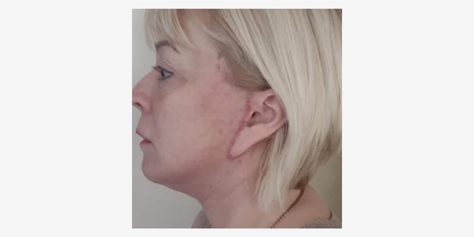 5 Signs of a Botched Facelift | RealSelf News