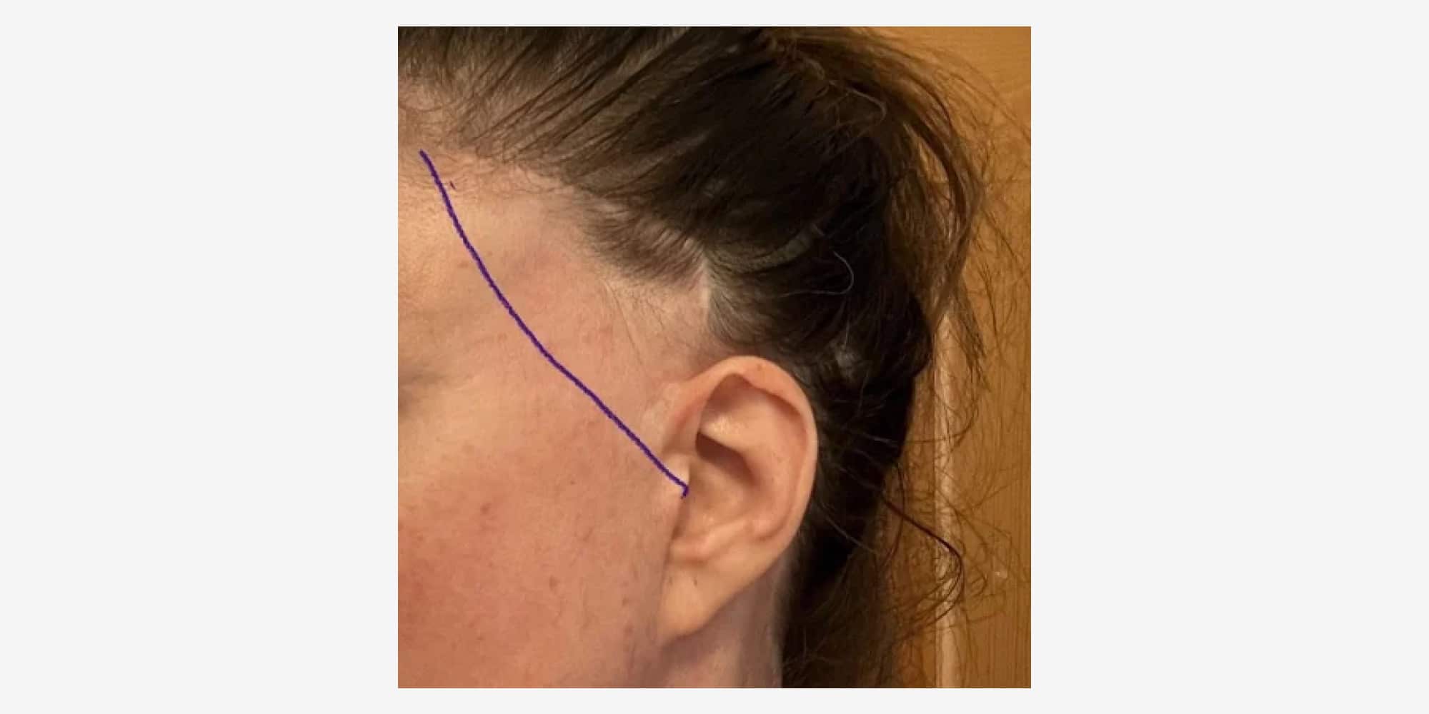 5 Signs of a Botched Facelift | RealSelf News