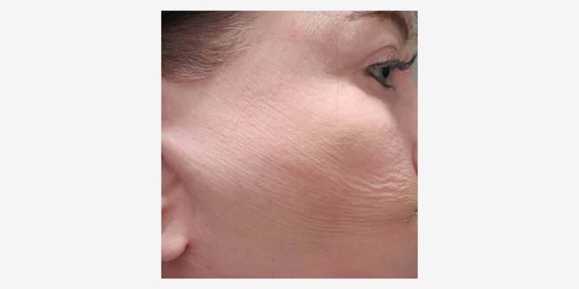 5 Signs of a Botched Facelift | RealSelf News