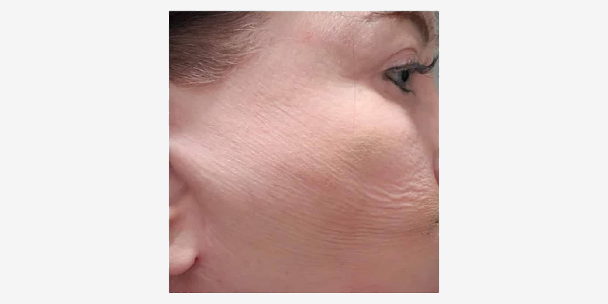 5 Signs of a Botched Facelift | RealSelf News