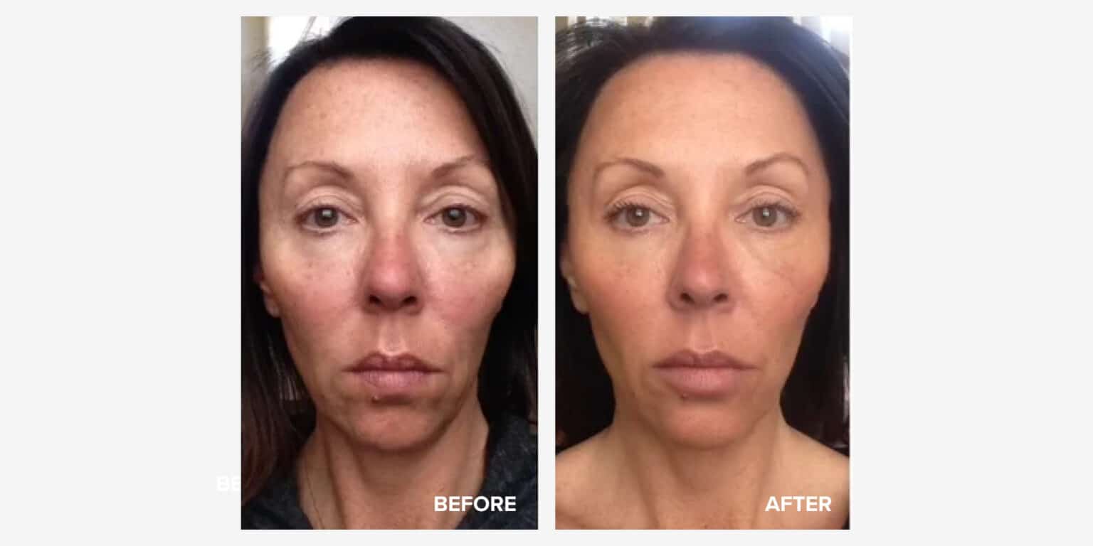 6 Best Sculptra Before and After Photos | RealSelf News