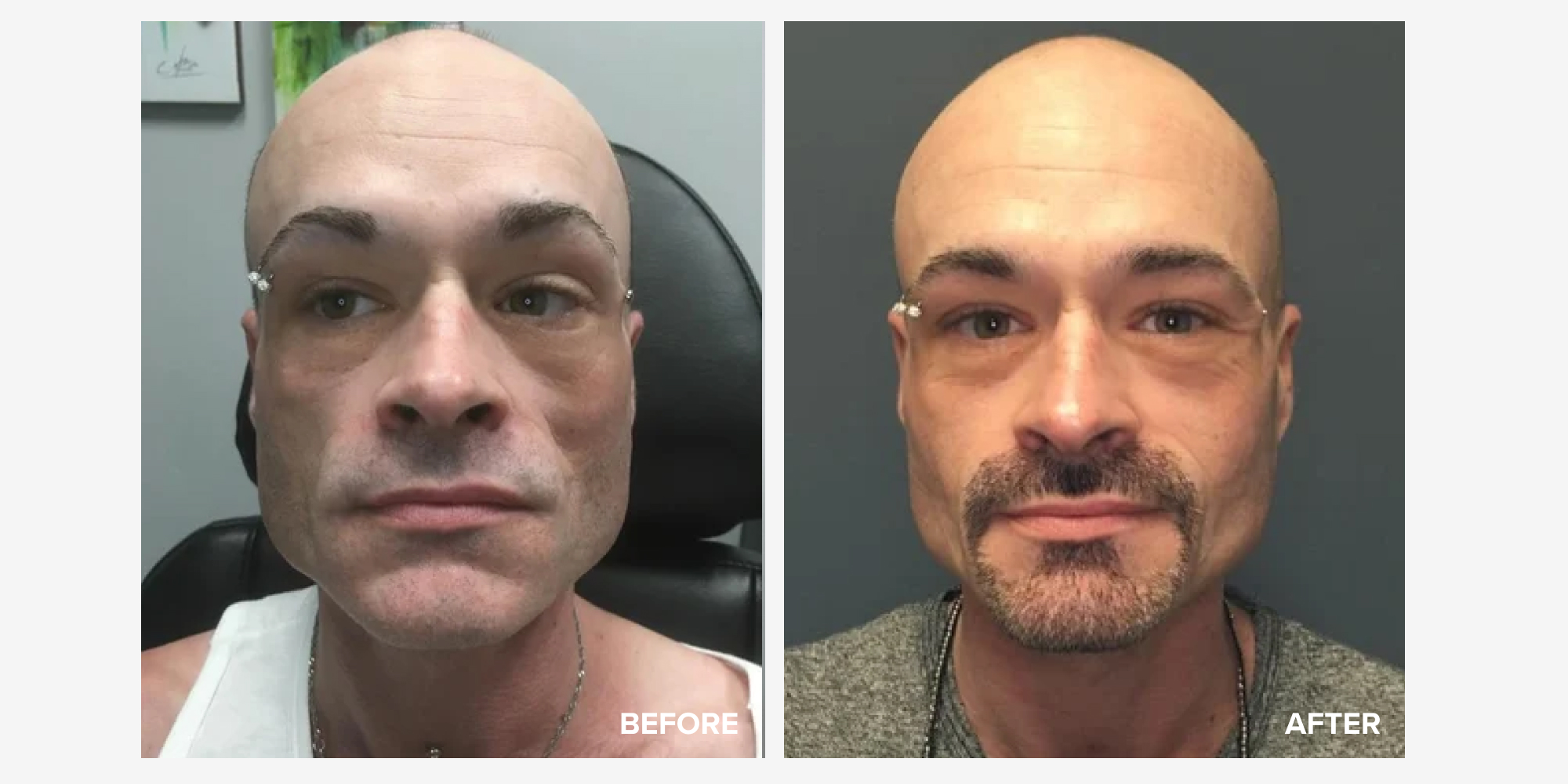 6 Best Sculptra Before and After Photos | RealSelf News